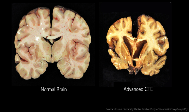 Of Known Cases Professional Boxers Show Most Debilitating CTE Symptoms ...